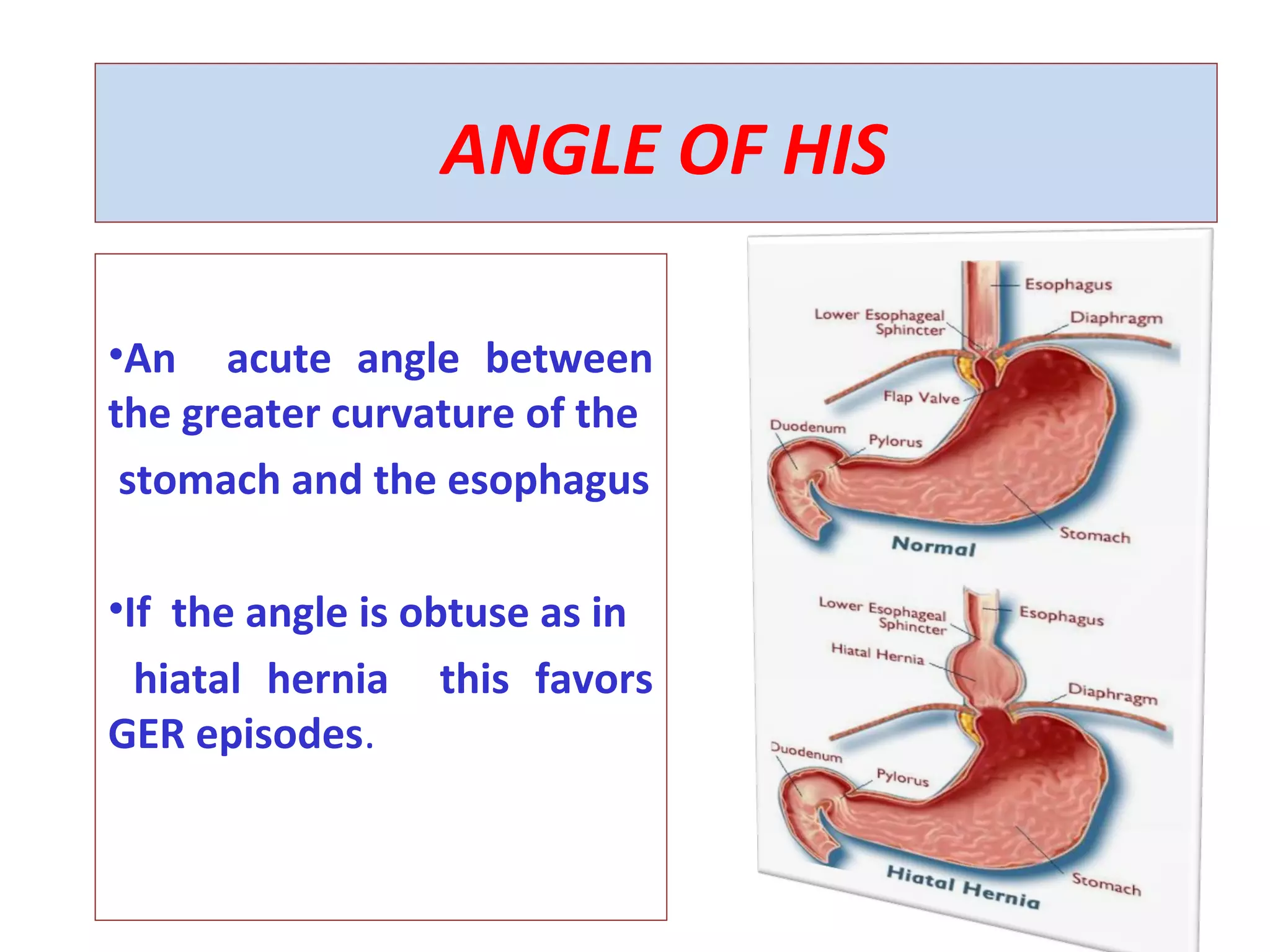 GERD IN CHILDREN | PPT