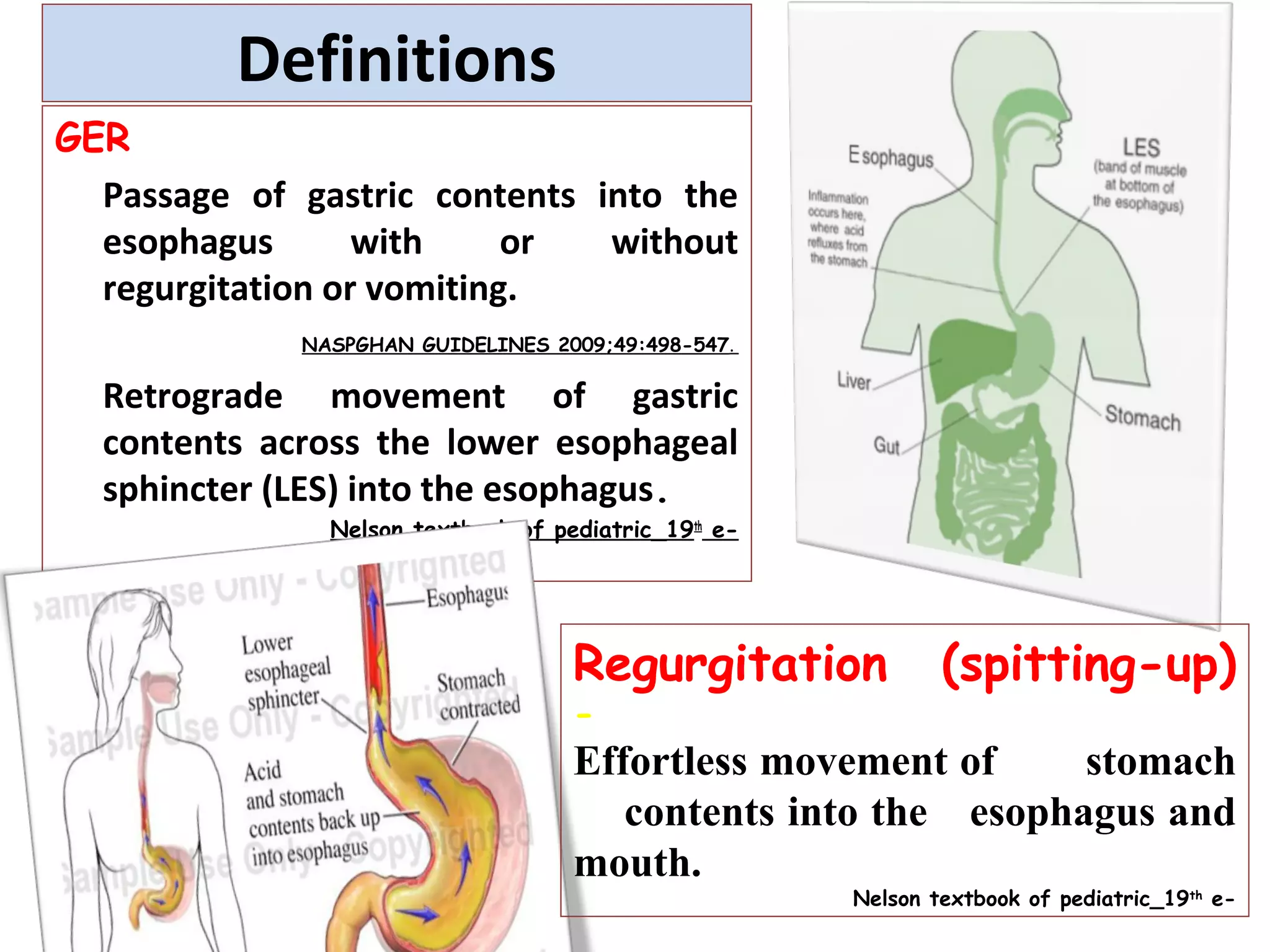 GERD IN CHILDREN | PPT