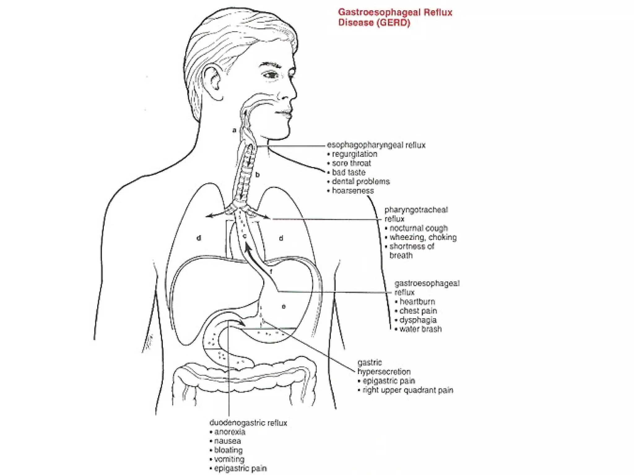 GERD IN CHILDREN | PPT