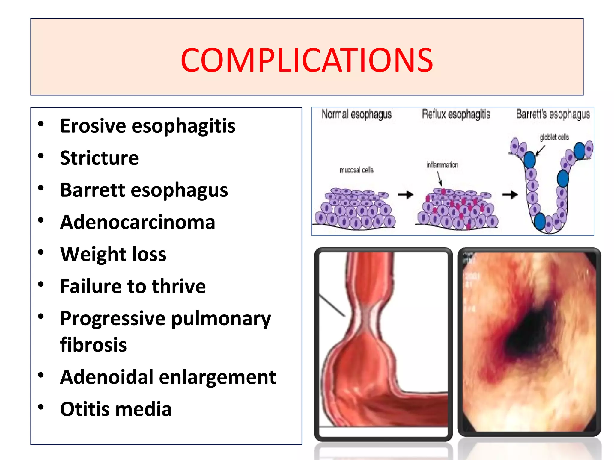 GERD IN CHILDREN | PPT