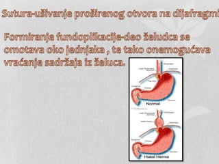 Gastroezofagealna refluksna bolest (GERB) | PPT
