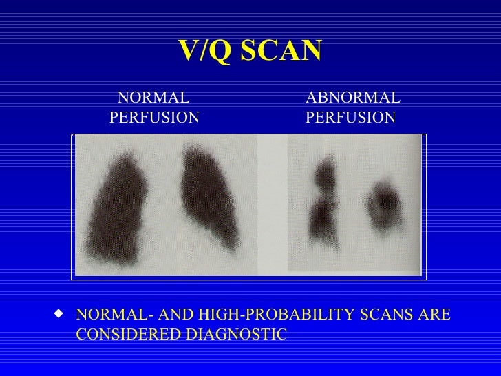 Gerber Pulmonary Embolism