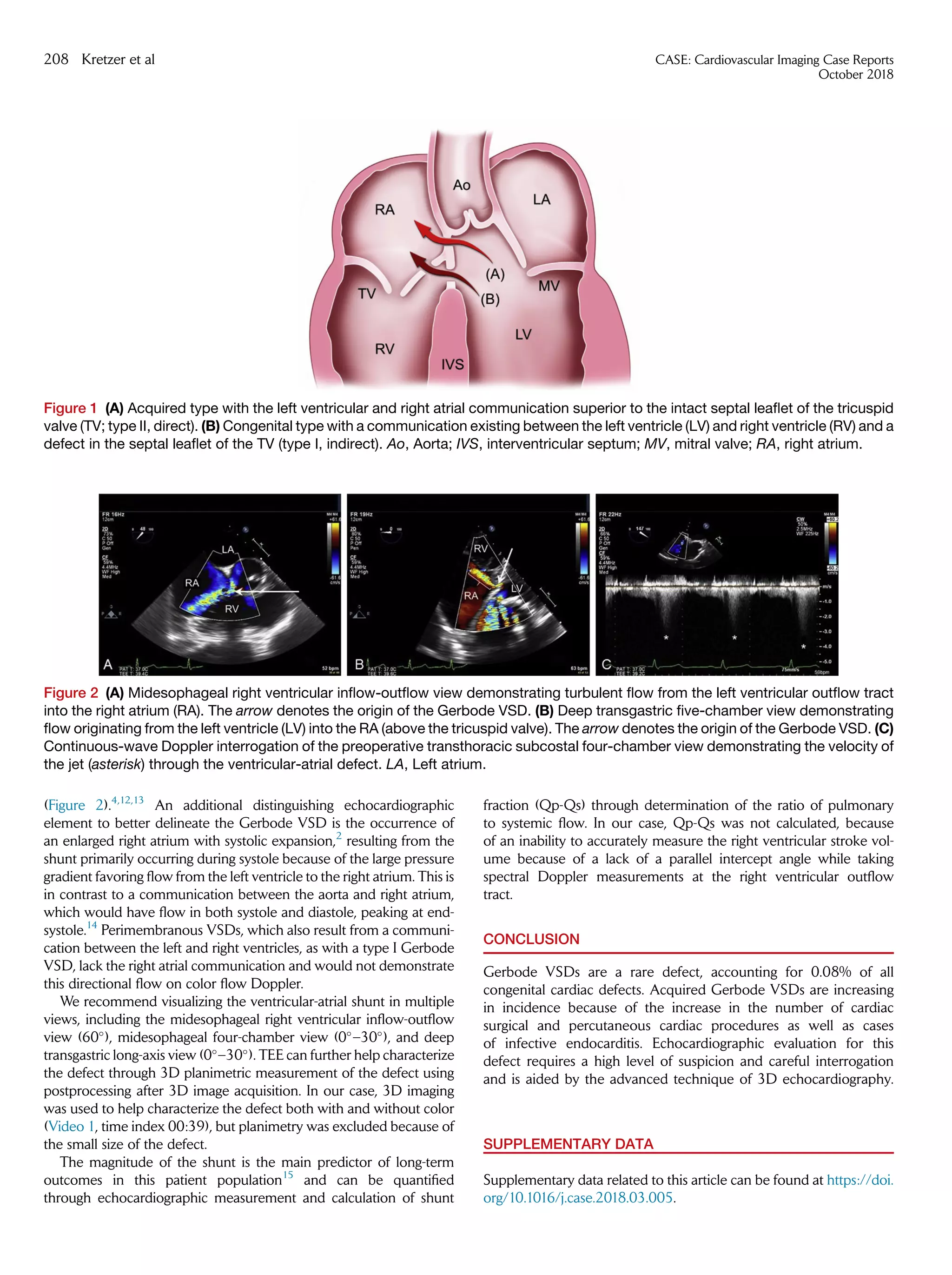 Gerbode ventricular septal defect | PDF