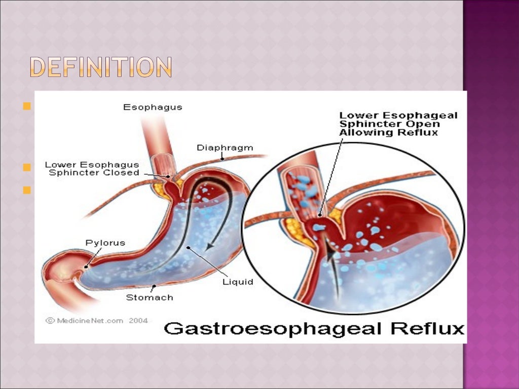 Gastric Reflux