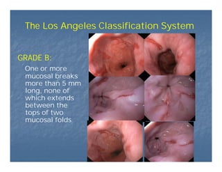 Gastroesophageal reflux disease | PDF