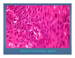 Gastroesophageal reflux disease | PDF