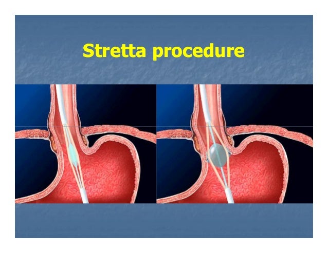 Gastroesophageal reflux disease