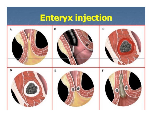 Gastroesophageal reflux disease