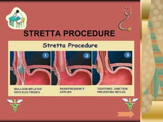 GASTROINTESTINAL REFLUX DISEASE (GERD) | PPT