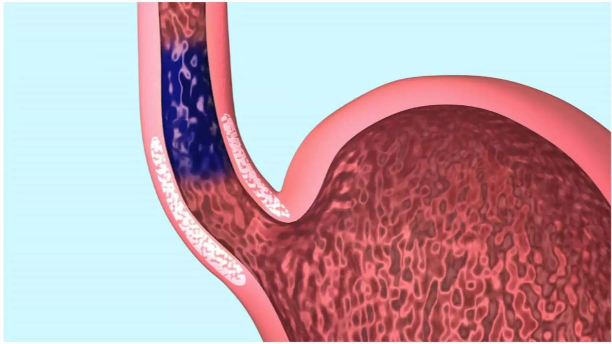 Reflux esophagitis or Gastroesophageal reflux disorder | PPTX