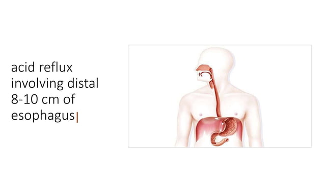 Reflux esophagitis or Gastroesophageal reflux disorder | PPTX ...