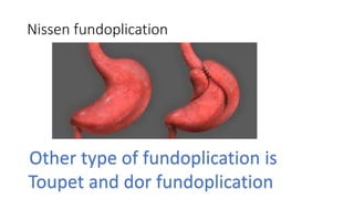 Reflux esophagitis or Gastroesophageal reflux disorder | PPTX