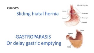 Reflux esophagitis or Gastroesophageal reflux disorder | PPTX