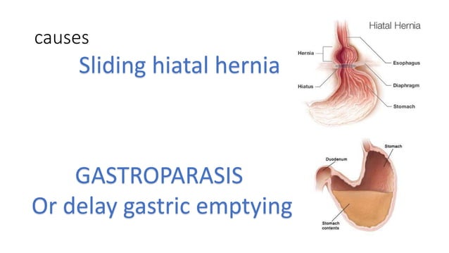 Reflux esophagitis or Gastroesophageal reflux disorder | PPTX ...