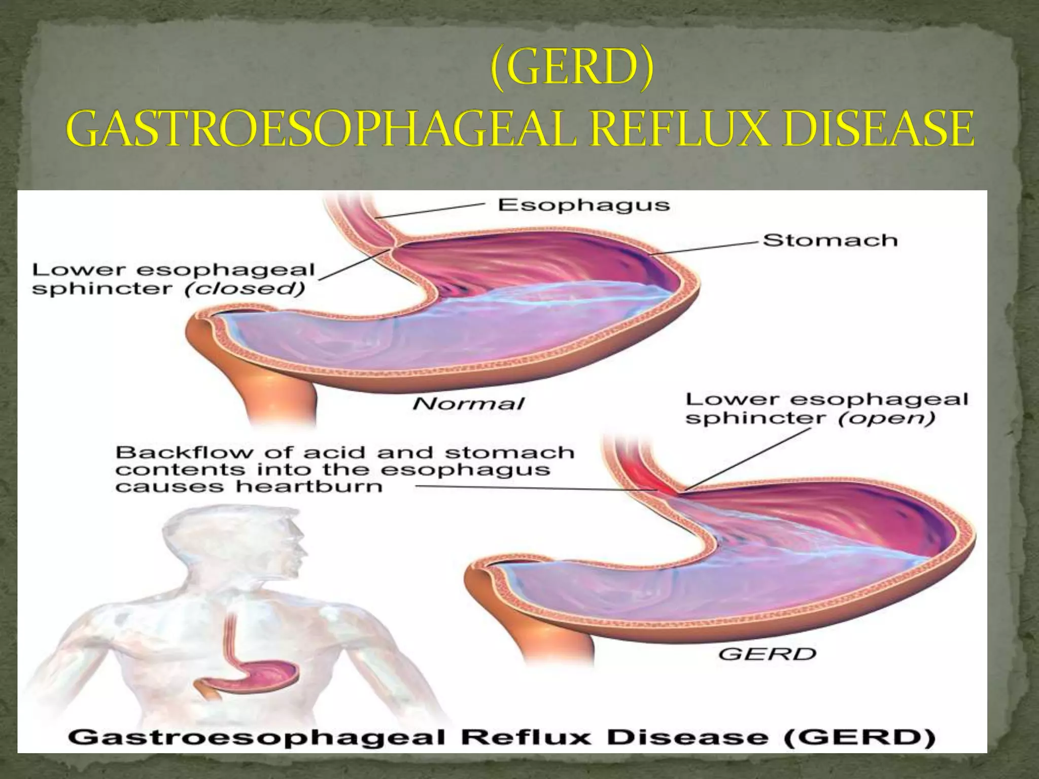 Gerd | PPT
