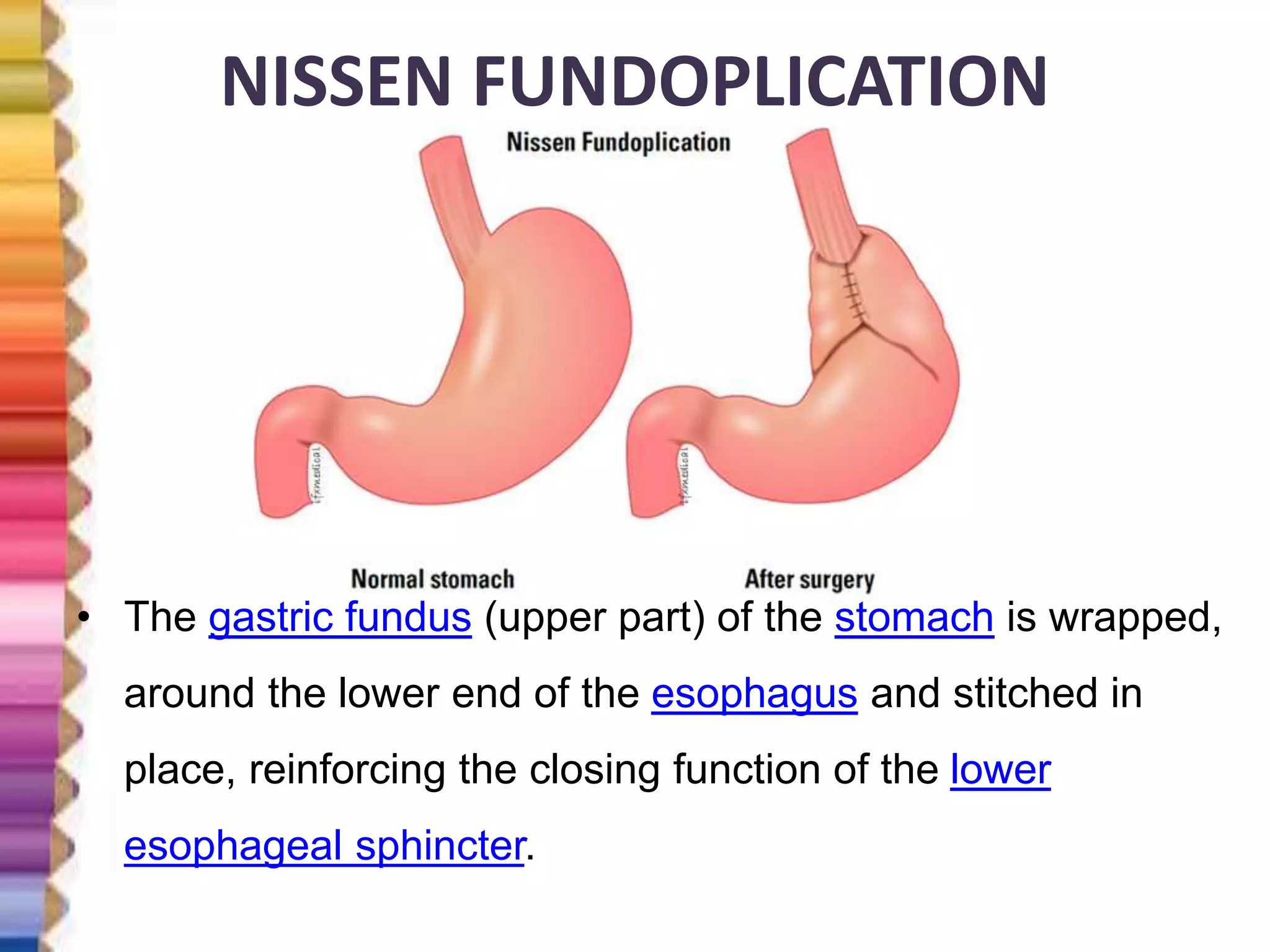 GASTRO ESOPHAGEAL REFLUX DISEASE | PPTX