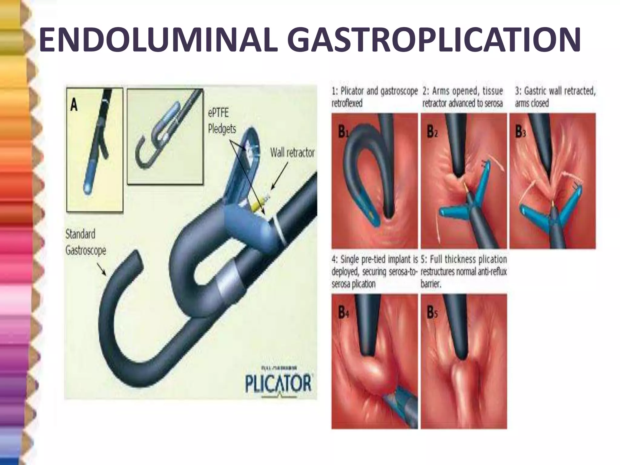 GASTRO ESOPHAGEAL REFLUX DISEASE | PPTX