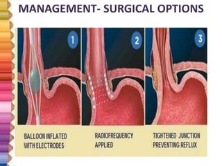 GASTRO ESOPHAGEAL REFLUX DISEASE | PPTX