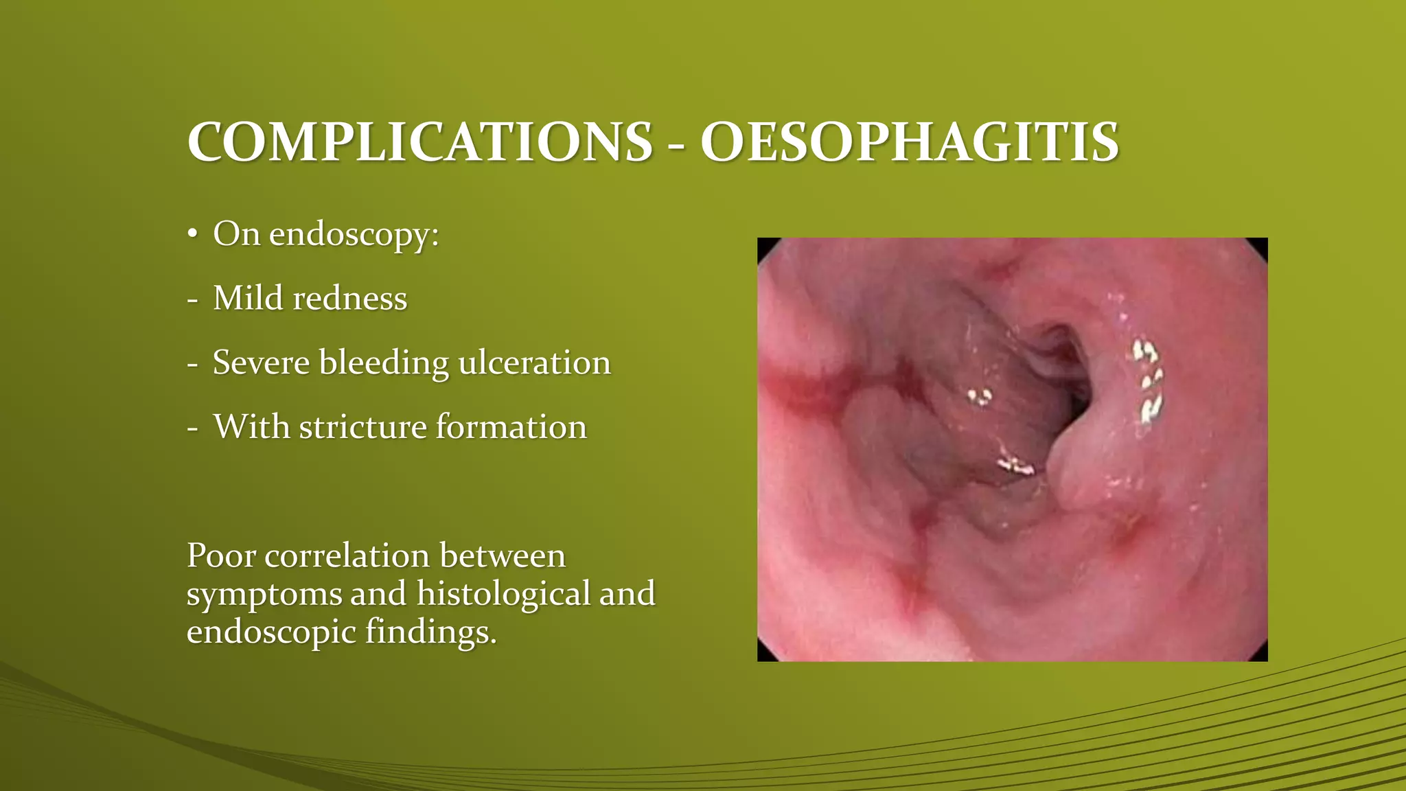 Gastroesophageal Reflux Disease (GERD) | PPTX