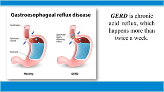 Gerd | PPT
