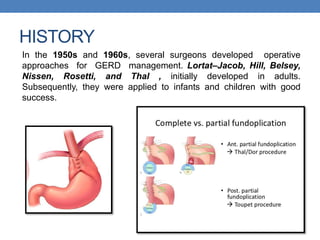 Thal Fundoplication