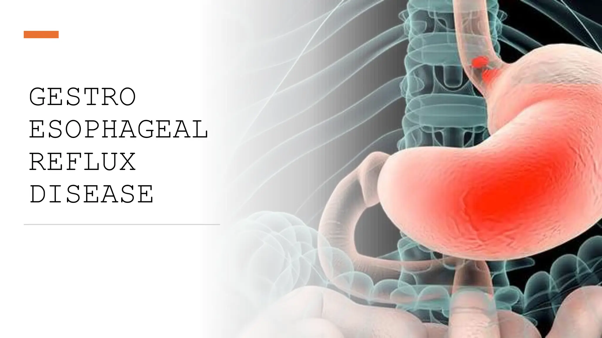 GERD gastro esophageal reflux disease.pptx