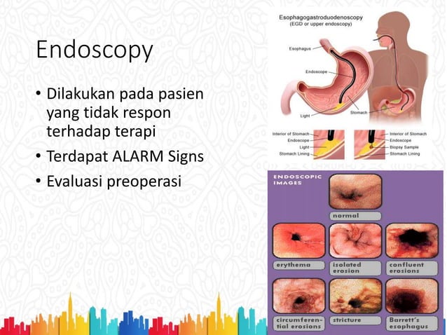 GERD gatroesofageal reflux disease (GERD) | PPT