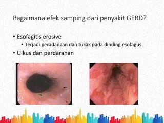 GERD gatroesofageal reflux disease (GERD) | PPT