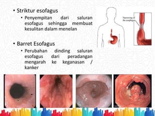 GERD gatroesofageal reflux disease (GERD) | PPT