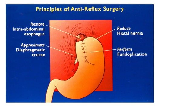 GAROINTESTINAL REFLUX DESEASE , REGURGITATION | PPTX | Digestive ...
