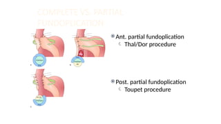 GAROINTESTINAL REFLUX DESEASE , REGURGITATION | PPTX