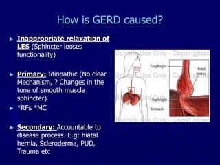 Gastro Esophageal Reflux Disease | PPT