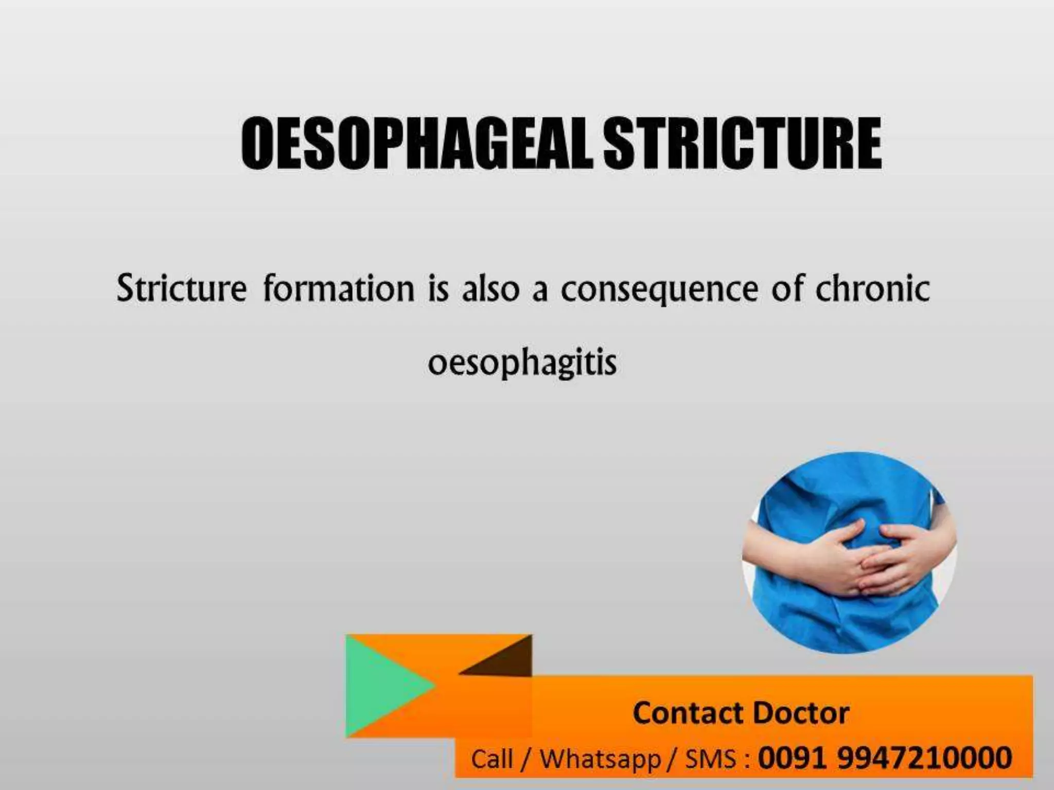 Everything you should know about GERD - Doctor Answers | PPTX