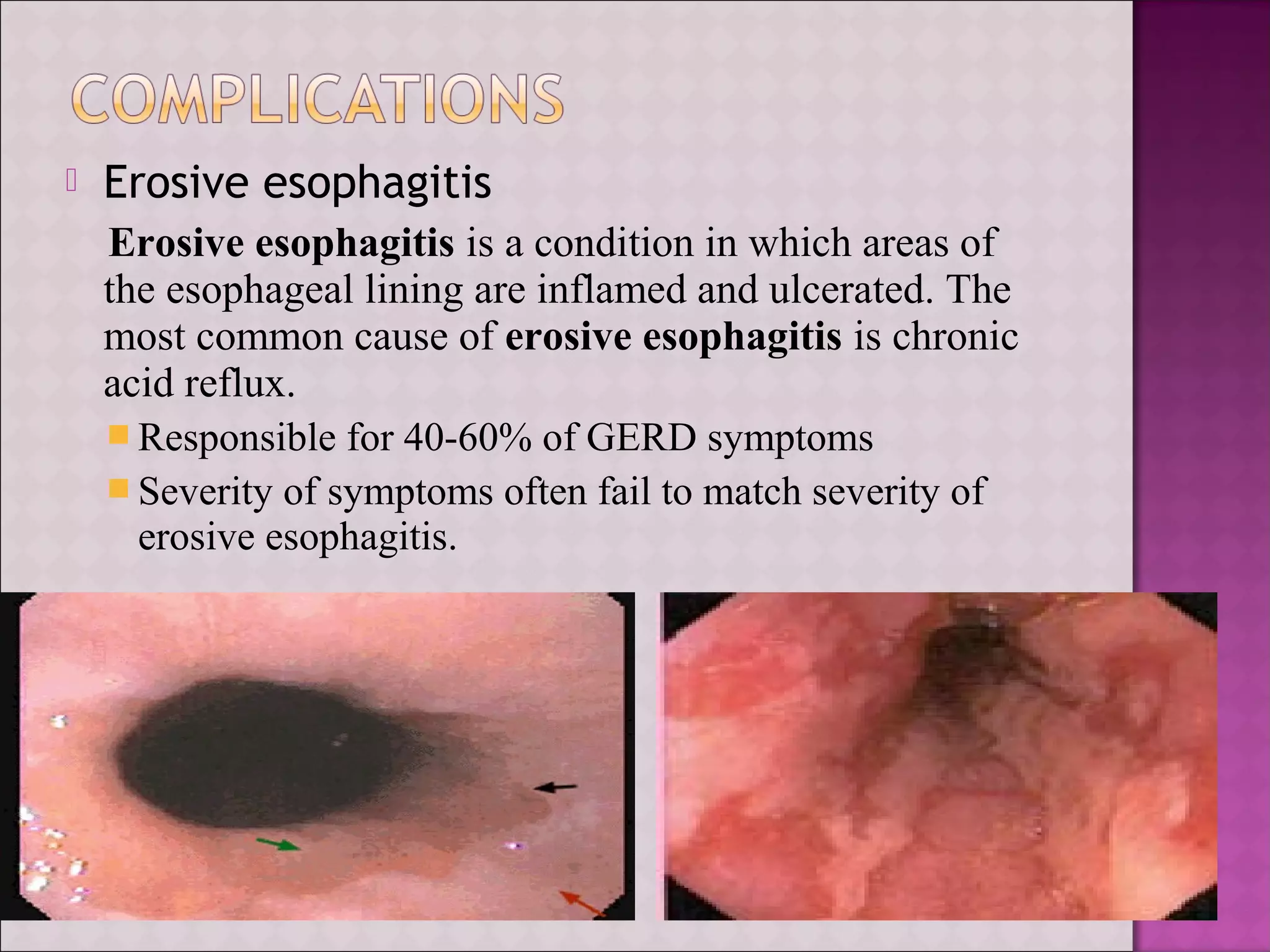 Gastro esophageal Reflux Disease (GERD) and its management | PPT
