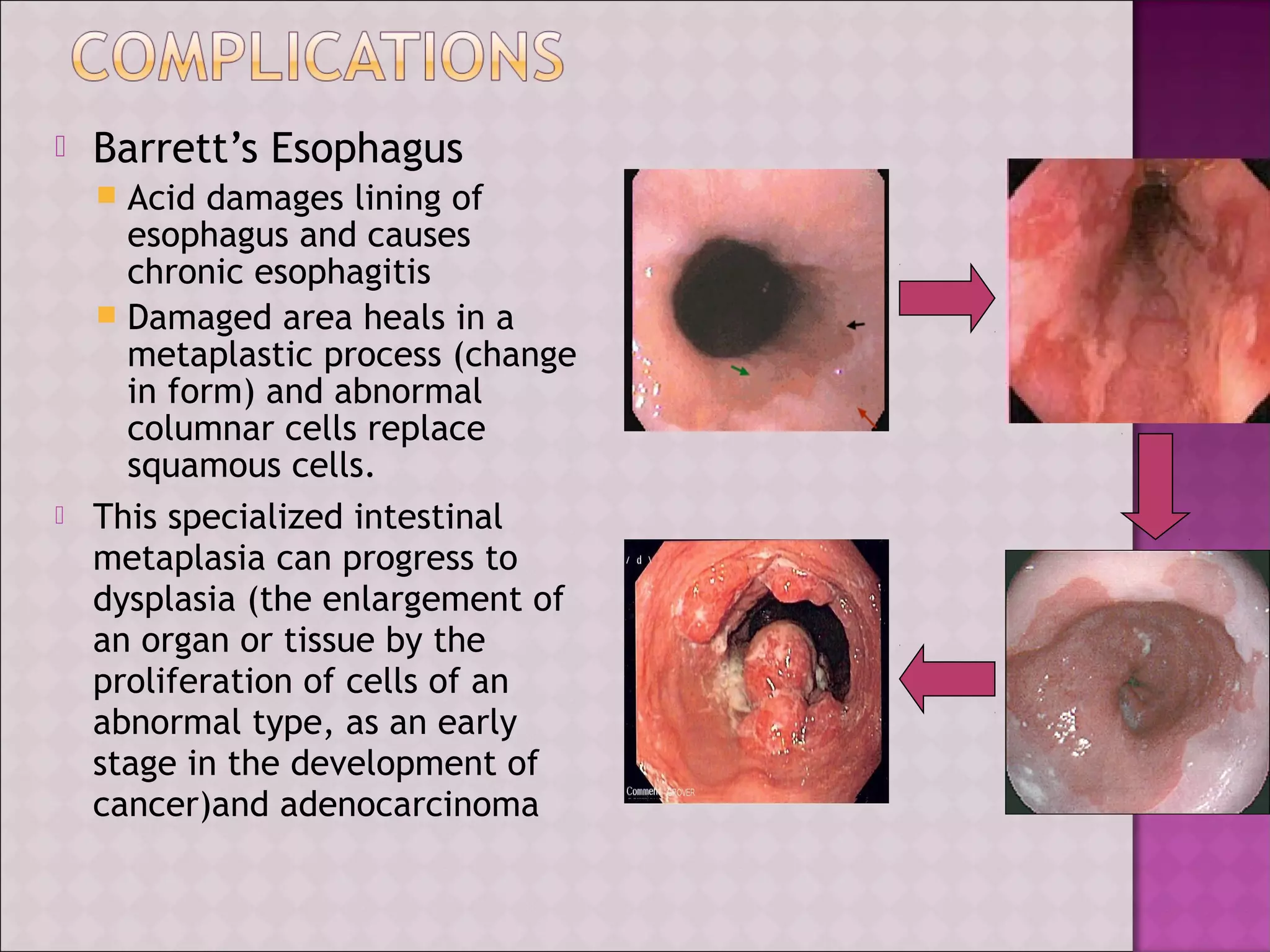Gastro esophageal Reflux Disease (GERD) and its management | PPT