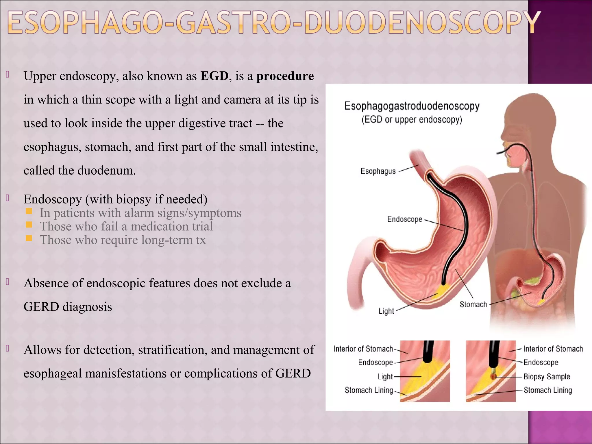 Gastro esophageal Reflux Disease (GERD) and its management | PPT