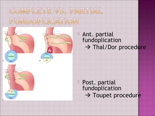 Thal Fundoplication