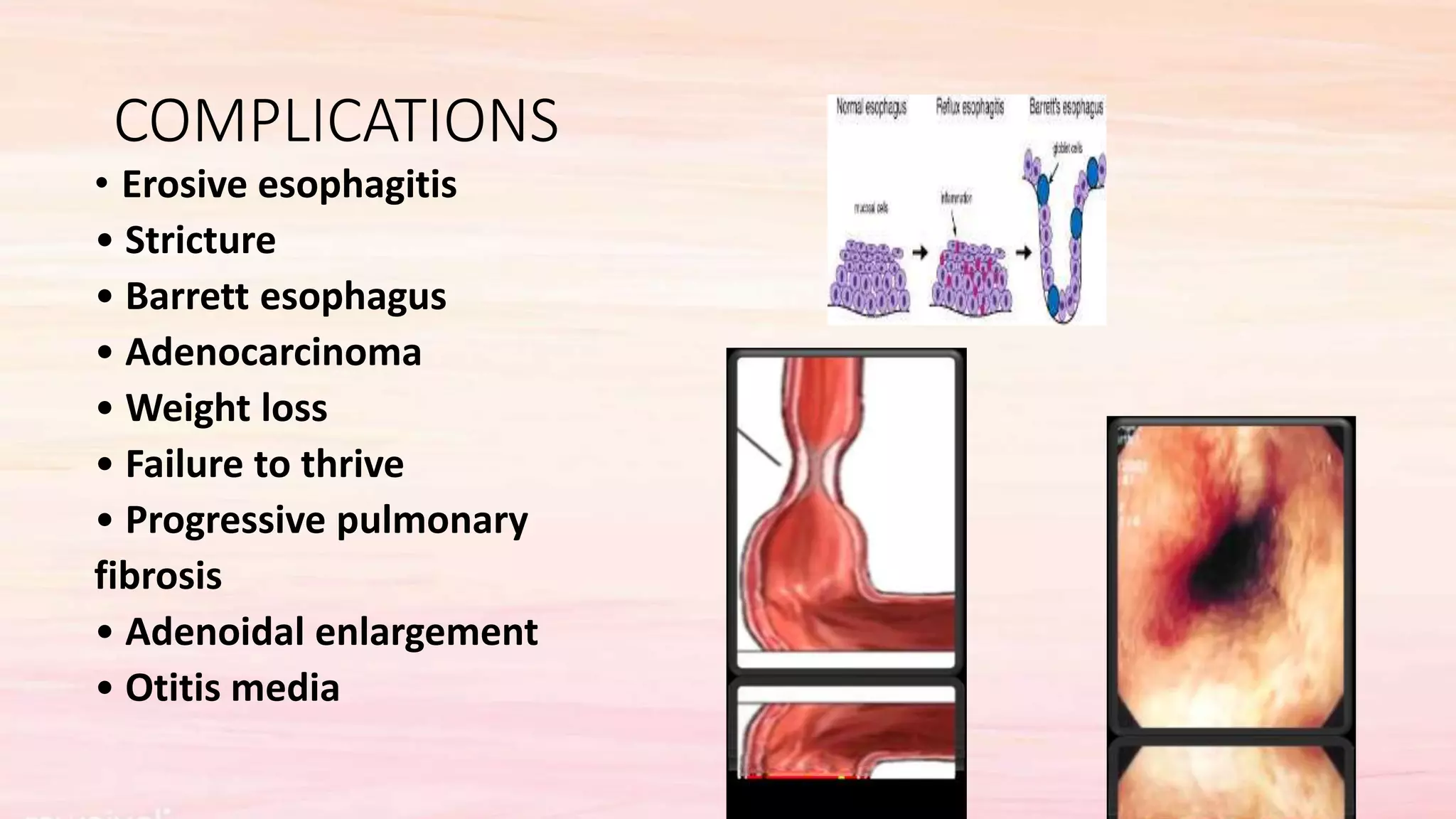 Gastroesophageal reflux disease in children.Indian Society of Pediatric ...