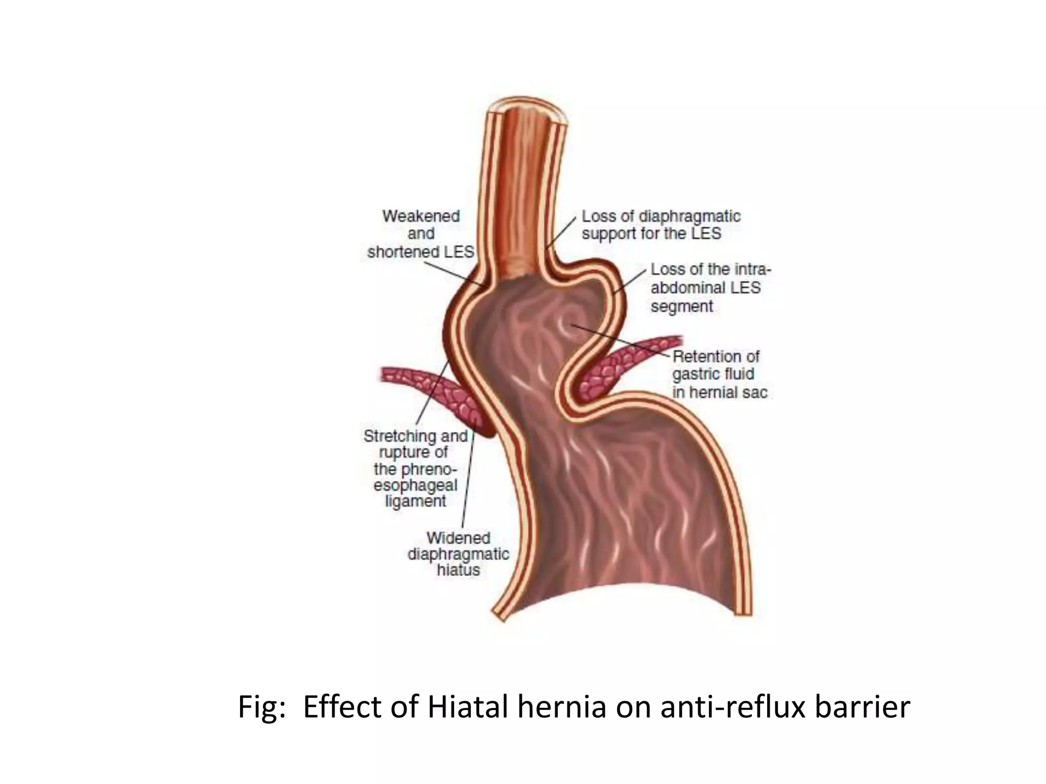 GERD and Barrett esophagus.pptx · version 1.pptx