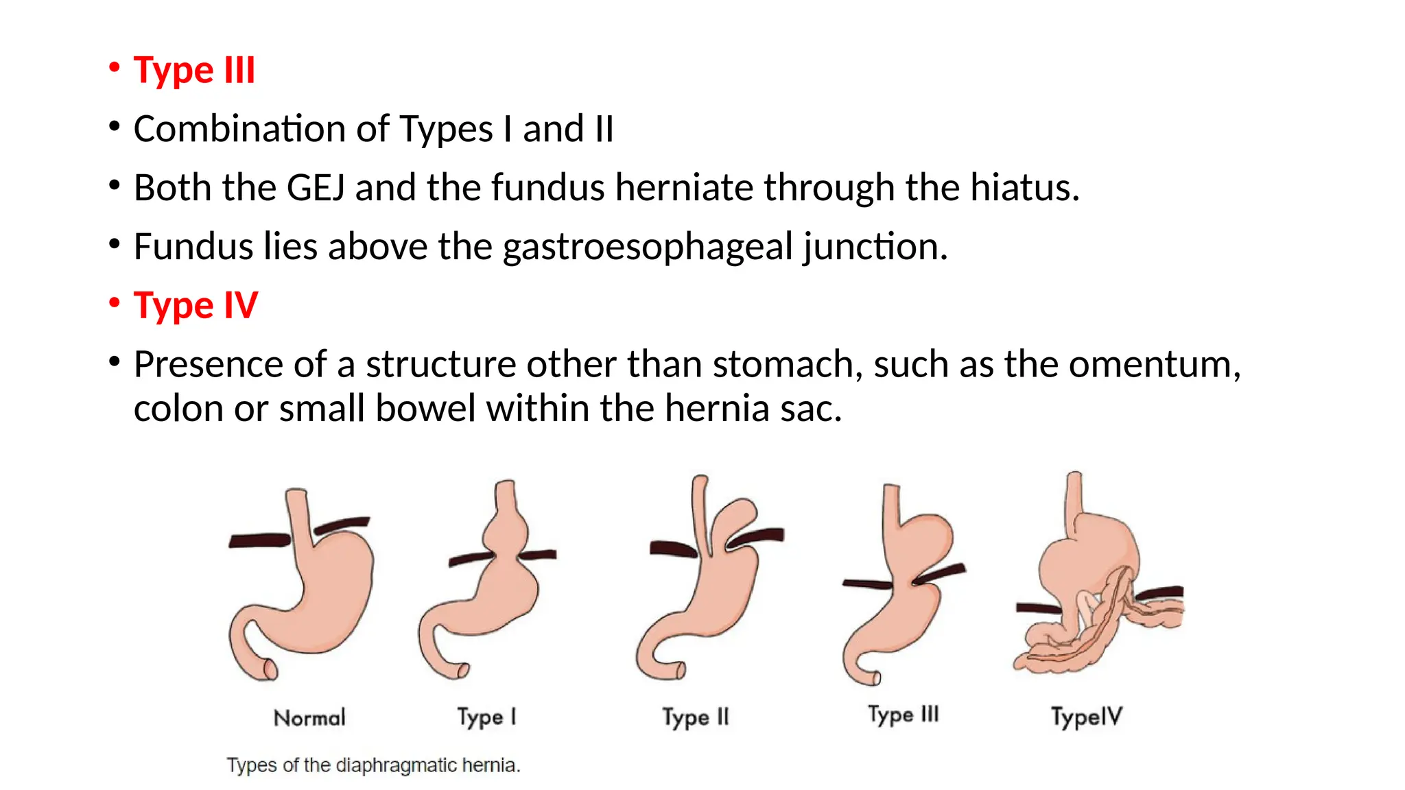 GERD And Diaphragmatic Hernia-1 (1).pptx