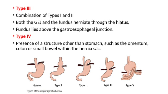 GERD And Diaphragmatic Hernia-1 (1).pptx