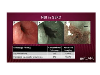 GERD / GASTRO ESOPHAGEAL REFLUX | PPTX