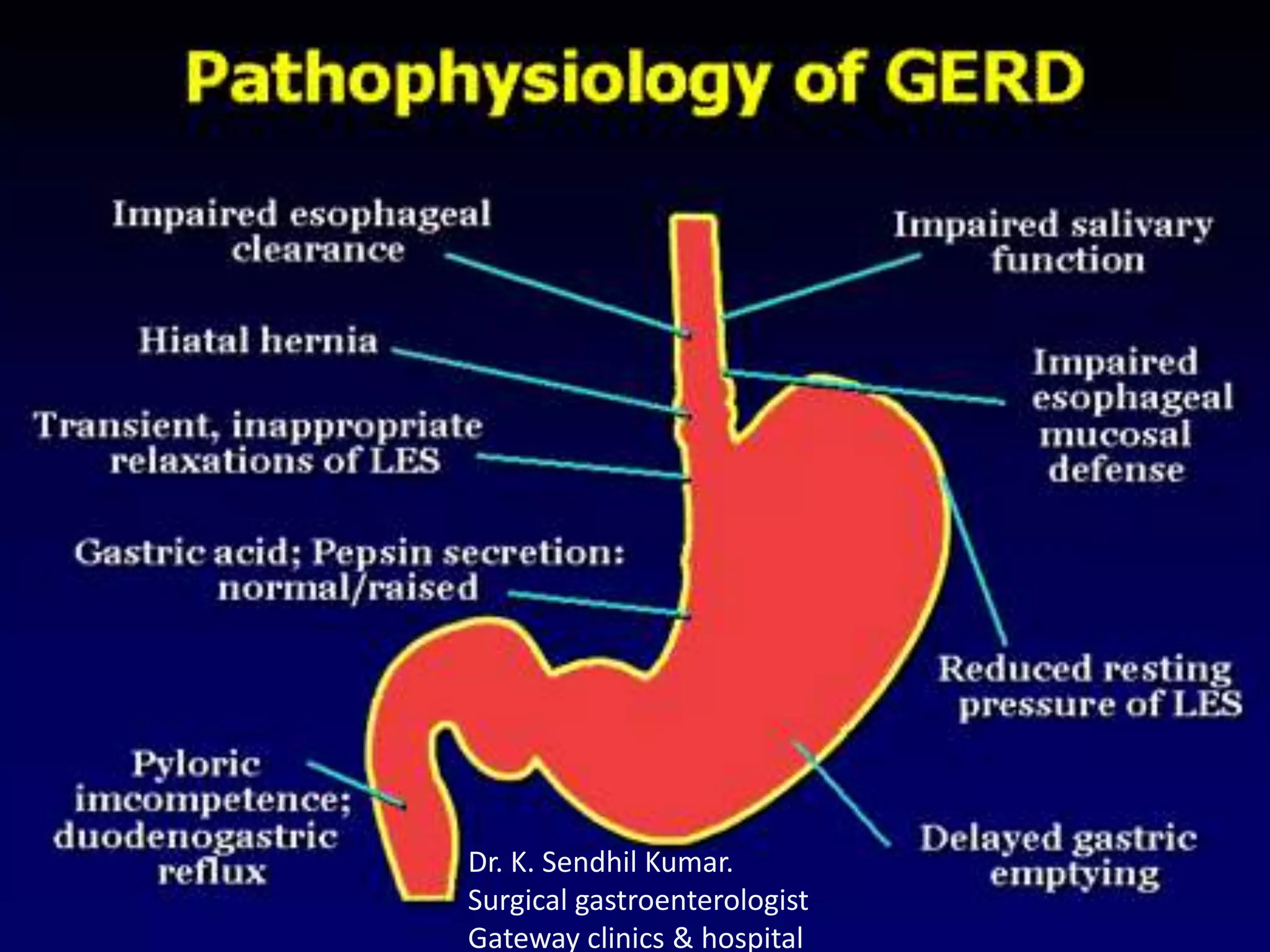 GERD | PPTX