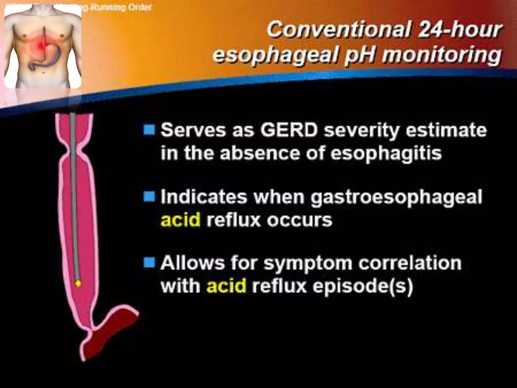 GERD,UNDERSTANDING | PPTX