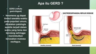 GERD k3.pptx
