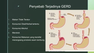 GERD k3.pptx