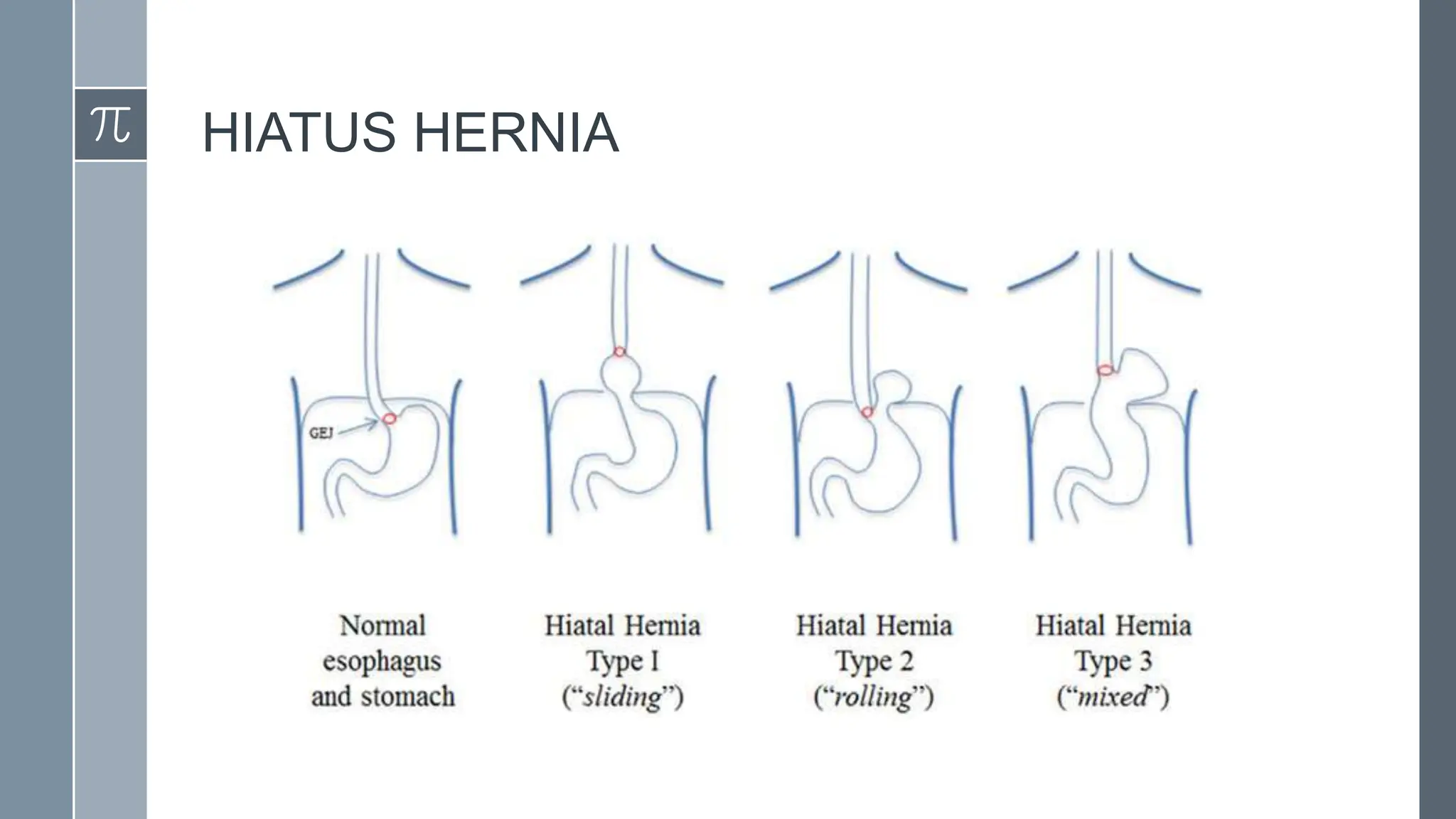 GERD, Perdarahan GI, Esophageal Atresia, Hernia Diafragma Kongenital ...