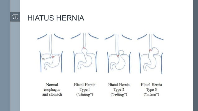 GERD, Perdarahan GI, Esophageal Atresia, Hernia Diafragma Kongenital ...