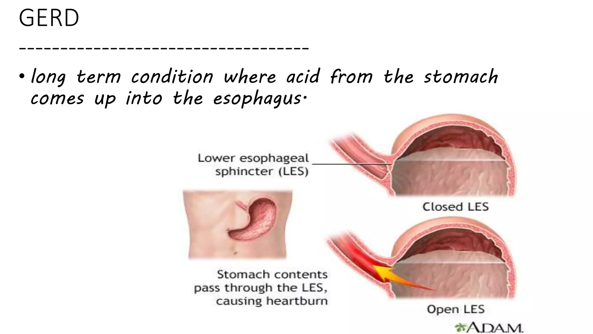 Gerd ppt | PPT | Free Download