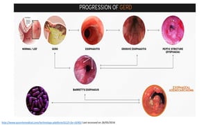 GERD PPT.pptx